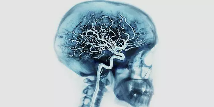 Angiografi af hjernens og nakkens kar: hvordan det udføres, og hvad det viser