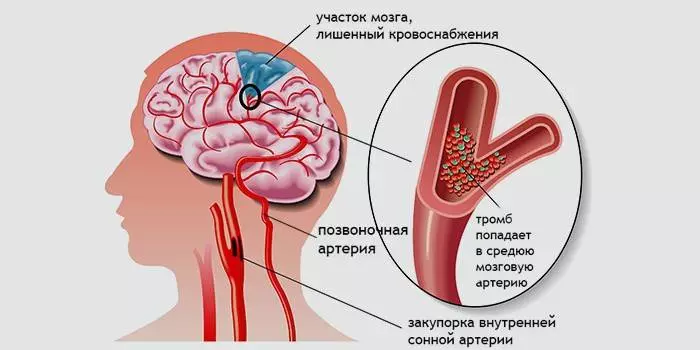 Xroniki beyin işemiyası: simptomlar, dərəcələr və müalicə