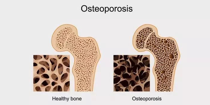 Faʻafefea ona togafitia le osteoporosis o sooga ma ponaivi i fafine i le fale