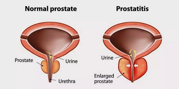 Què és la prostatitis