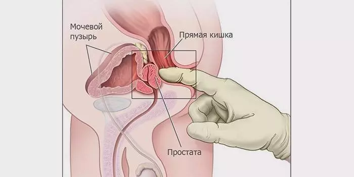 Masaža prostate