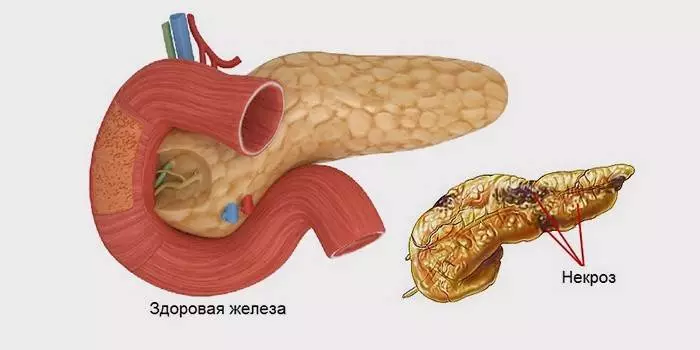 Neacróis pancreatach: cúiseanna agus comharthaí, prognóis agus cóireáil