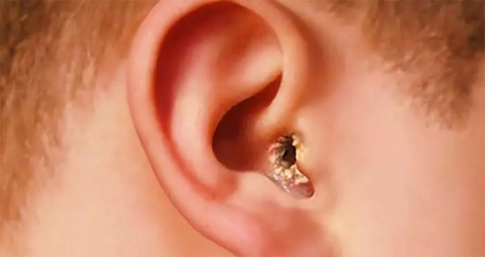 Ljudska gljiva ušiju