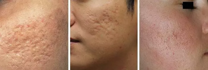 Creithiau acne