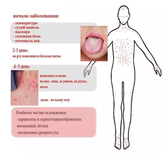 儿童和成人的麻疹症状：皮疹的体征和性质