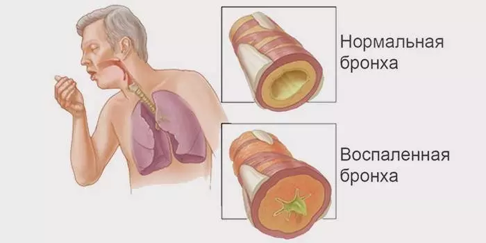 Expectorants pikeun bronchitis: ubar pangsaéna pikeun pangubaran