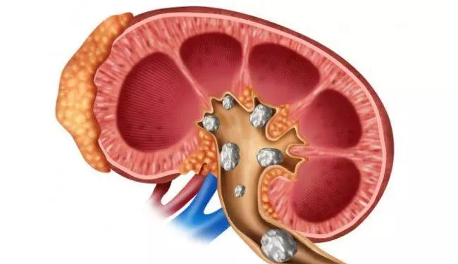 پیشاب سے بدبو کیوں آتی ہے؟ 10818_2