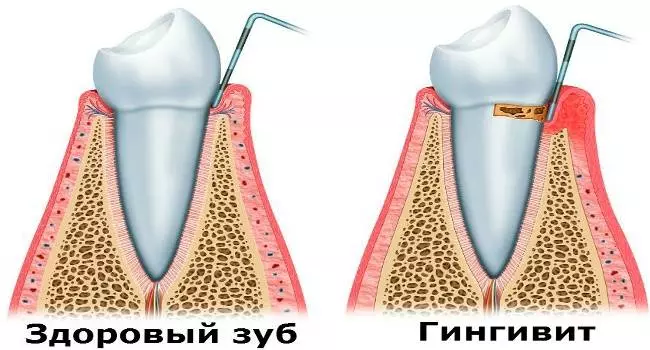 Cách nhận biết sớm bệnh nướu răng