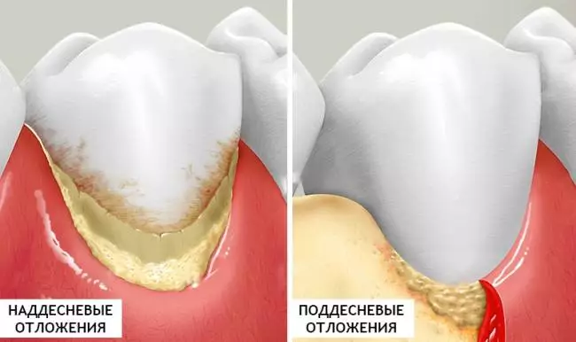 Тіс ауруын қалай ерте тануға болады 10986_2