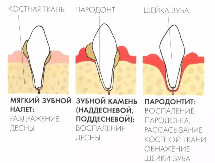 Тіс ауруын қалай ерте тануға болады 10986_3