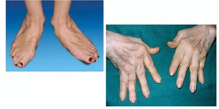 پيرن ۽ هٿن جي Rheumatoid arthritis