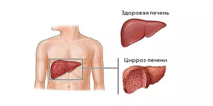 Ini lenye afya na ini iliyoathiriwa na ugonjwa wa cirrhosis