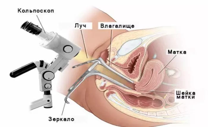 Nola biopsia utero-lepokoa higadurarekin