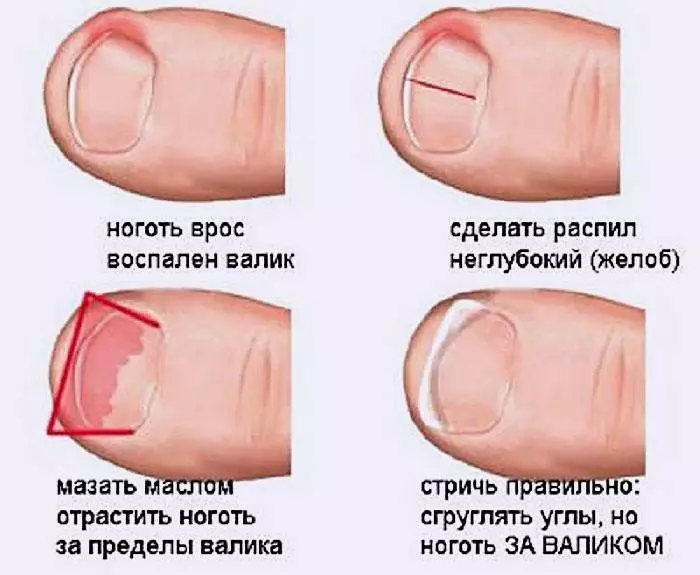 Tretmani za urasli nokat