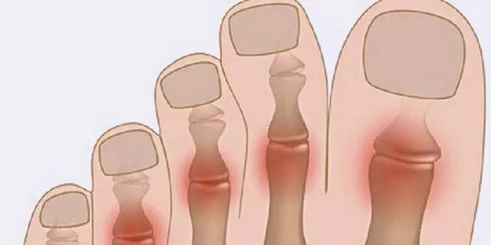Osteoartritis: jari kaki sakit