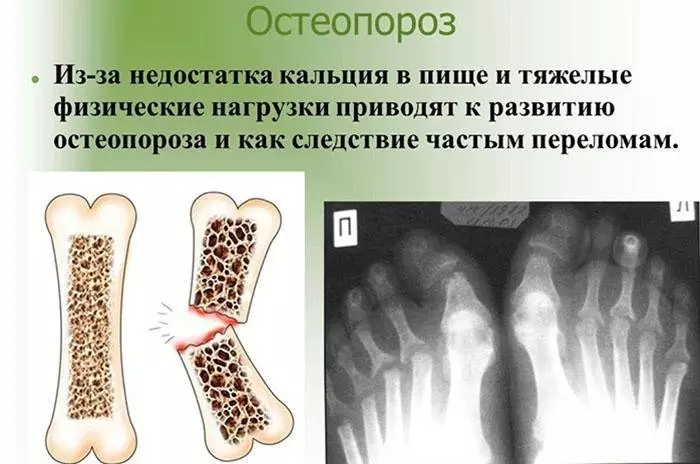 Ból osteoporozy