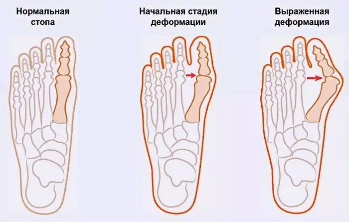 Зошто се формира и боли испакнатина на стапалото?