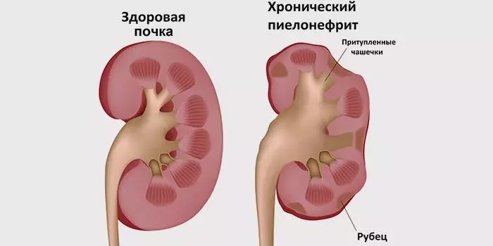 Здрав бубрег и пациент со пиелонефритис