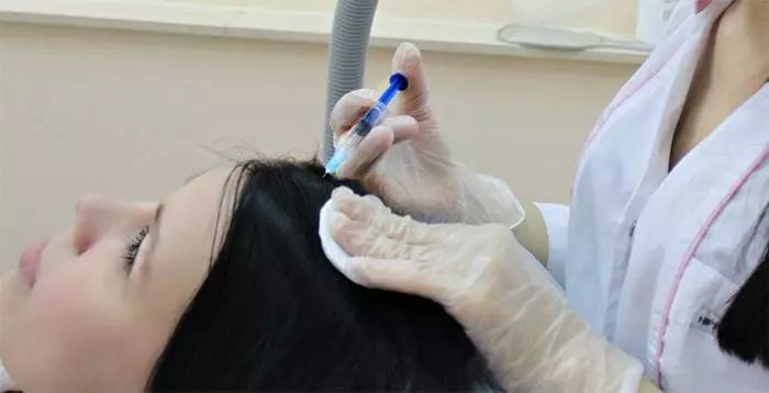 Mesotherapy to get rid of dandruff