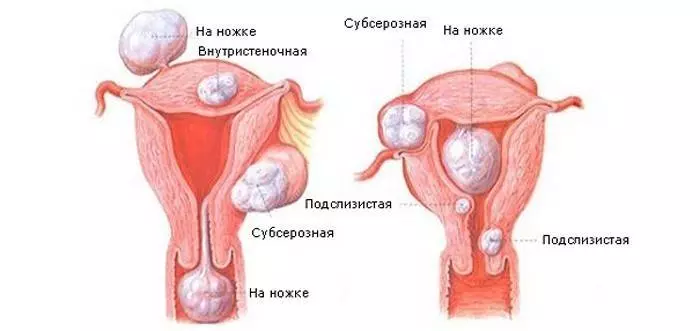 Ifibroma yesibeleko