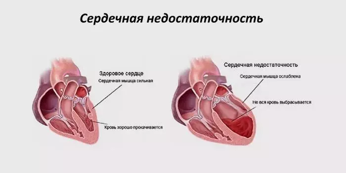 ئۆتكۈر تاجىسىمان يۈرەك زەئىپلىشىش