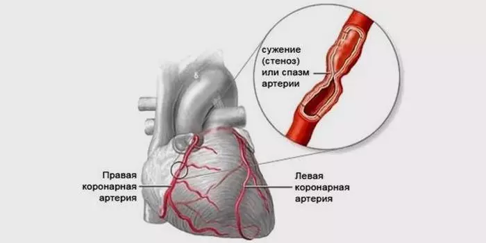 Ägeda koronaarpuudulikkuse põhjus
