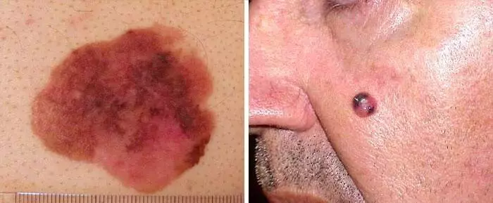 Melanoma in the early stages