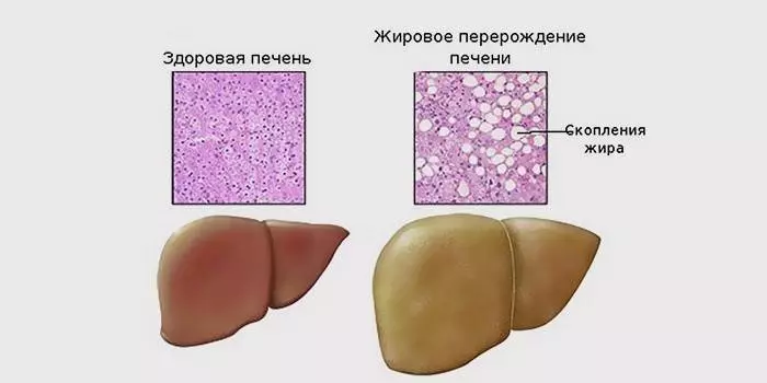 Rasvase hepatoosi ja terve maksa võrdlus