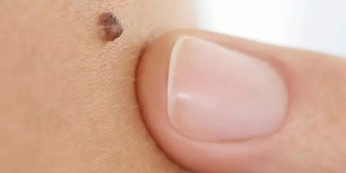 Nevus trên da là melanomone nguy hiểm