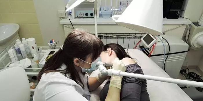 Một bác sĩ thẩm mỹ thực hiện loại bỏ nốt ruồi bằng laser ở một bệnh nhân