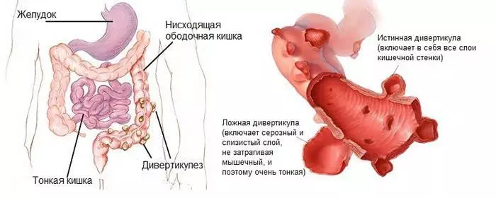 Diverticulosis an colon sigmoid