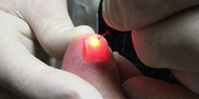 Процедура за лазерно отстраняване на врастнал нокът