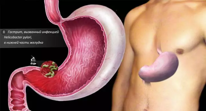 Antral eroziw gastrit