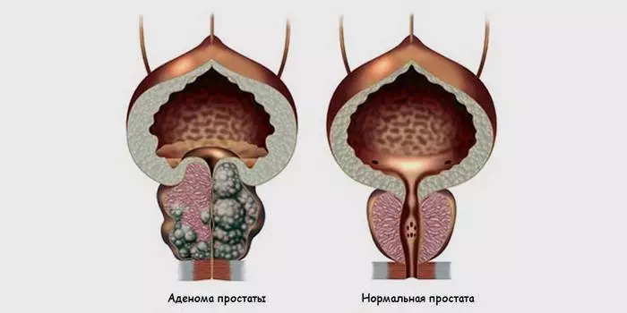 Próstatach gnáth agus adenoma