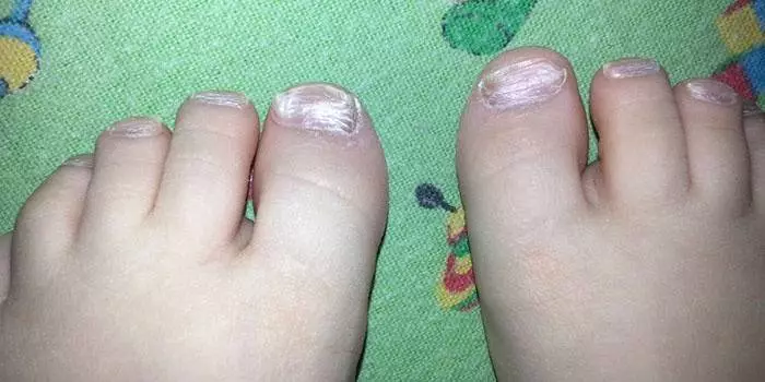 Gründe für die Entstehung der Nageldystrophie bei Kindern