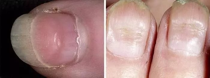 Äußere Merkmale der Nageldystrophie - Bo Furchen