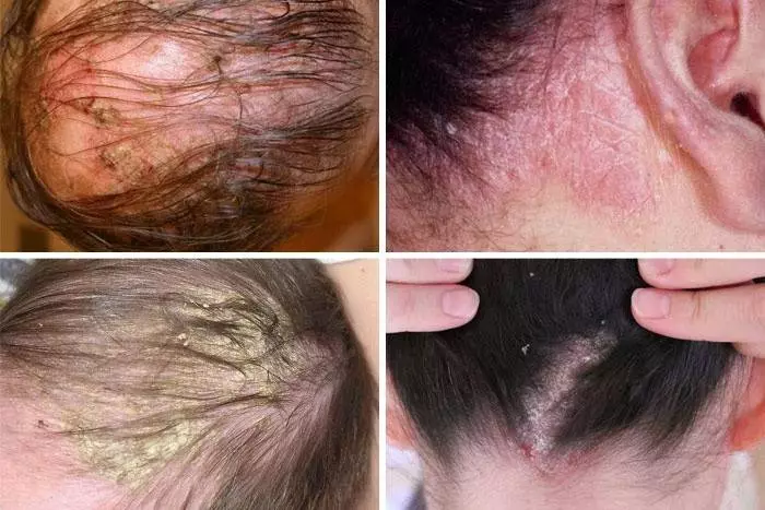 Dermatitis seboroik pada kulit kepala