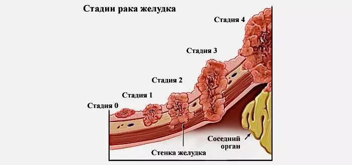 Stages of stomach cancer