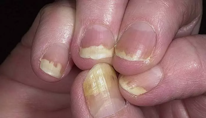 Ознаки псоріазу на нігтях рук