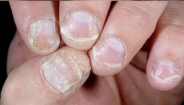 手の爪の乾癬の症状