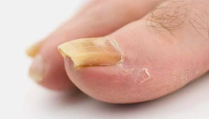Zizindikiro za toenail psoriasis