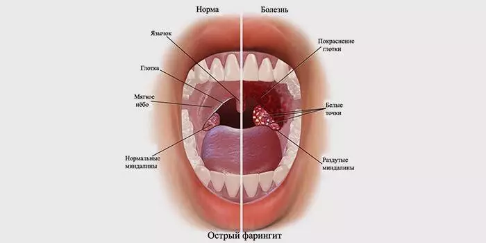 White spots on the throat with pharyngitis