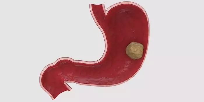 Hyperplastic polyp a ciki