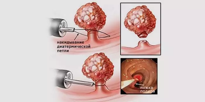 Operasi polypectomy pikeun miceun polip dina lambung