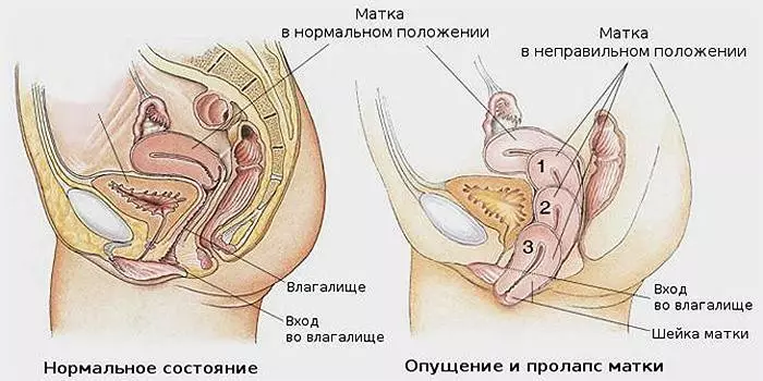 Prolapseya uterus di jinan de