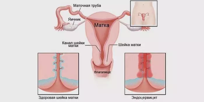 Endocervicitis - encama prolapsiya uterus