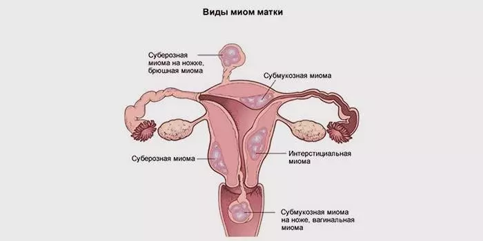 Cineálacha fibroids útarach