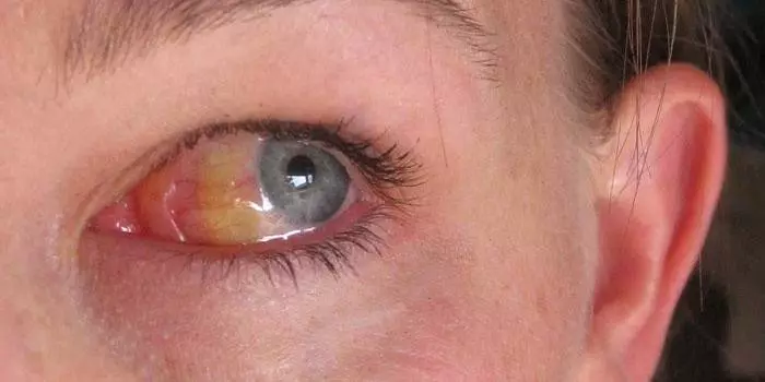 Gulfarging av øyets sclera