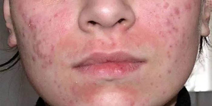 Demodekoza na koži lica
