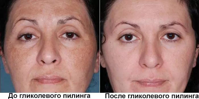 Gesicht foar en nei glycolyske peeling